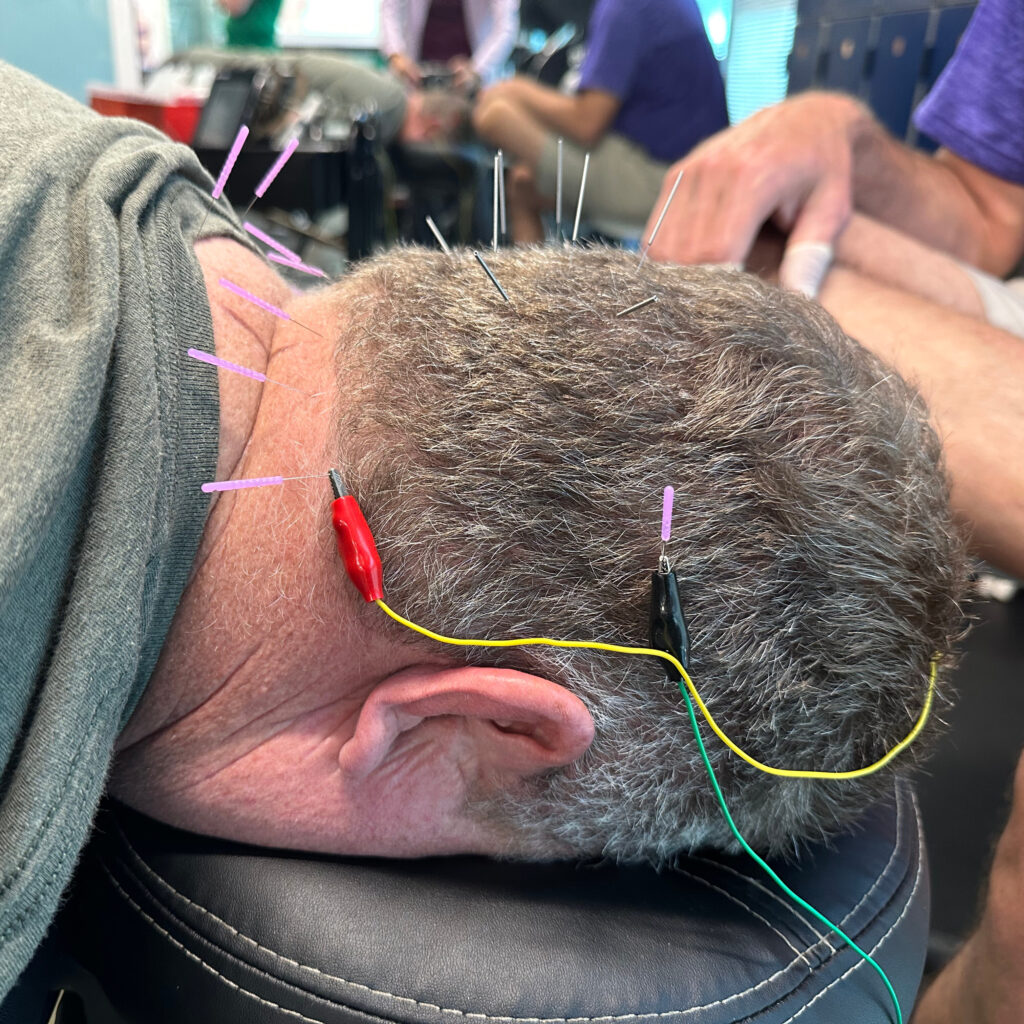 Advanced Dry Needling for the Head and Neck (SFDN-HN)